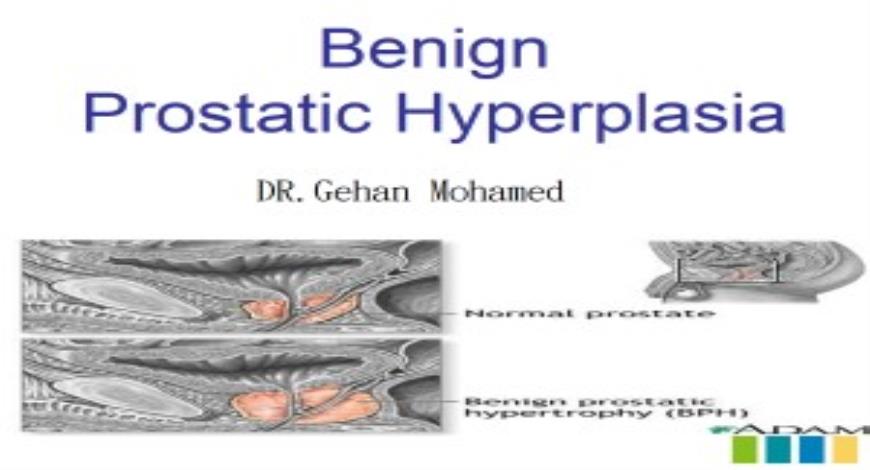 Free Download (BPH) Benign Prostatic Hyperplasia PowerPoint ...