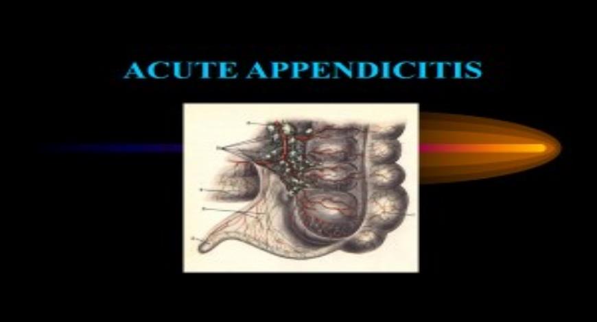 Free Download LEARN ABOUT ACUTE APPENDICITIS PowerPoint Presentation ...