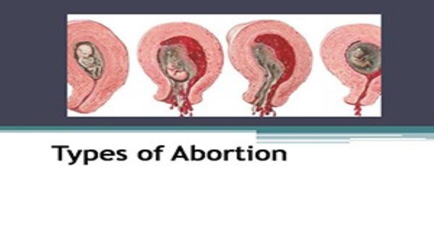 Free Download Types of Abortion PowerPoint Presentation | SlidesFinder.com