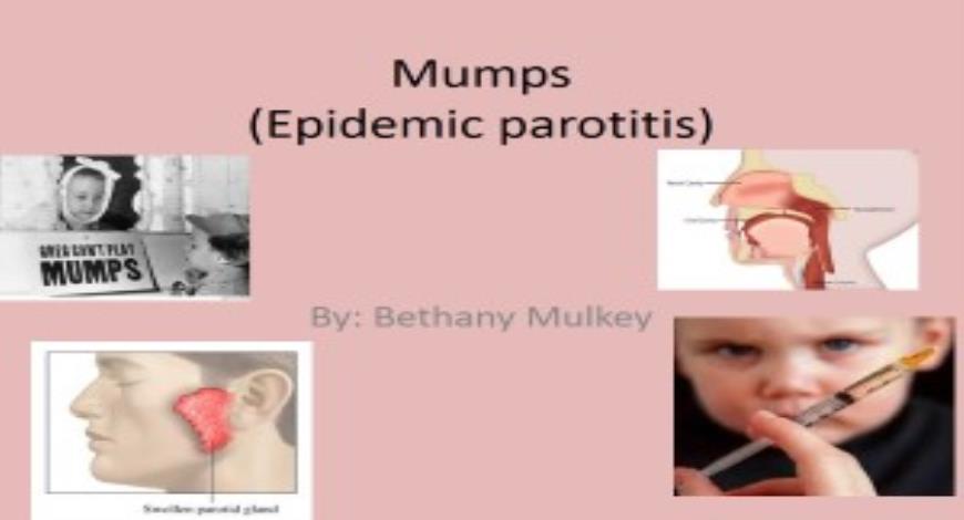 Free Download Mumps (Epidemic parotitis) PowerPoint Presentation Slides